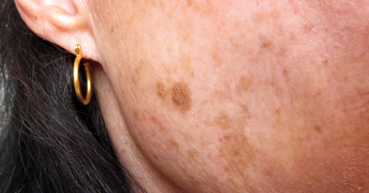 Tak pracujesz na starcze plamy. Dermatolożka: Polacy robią to na potęgę