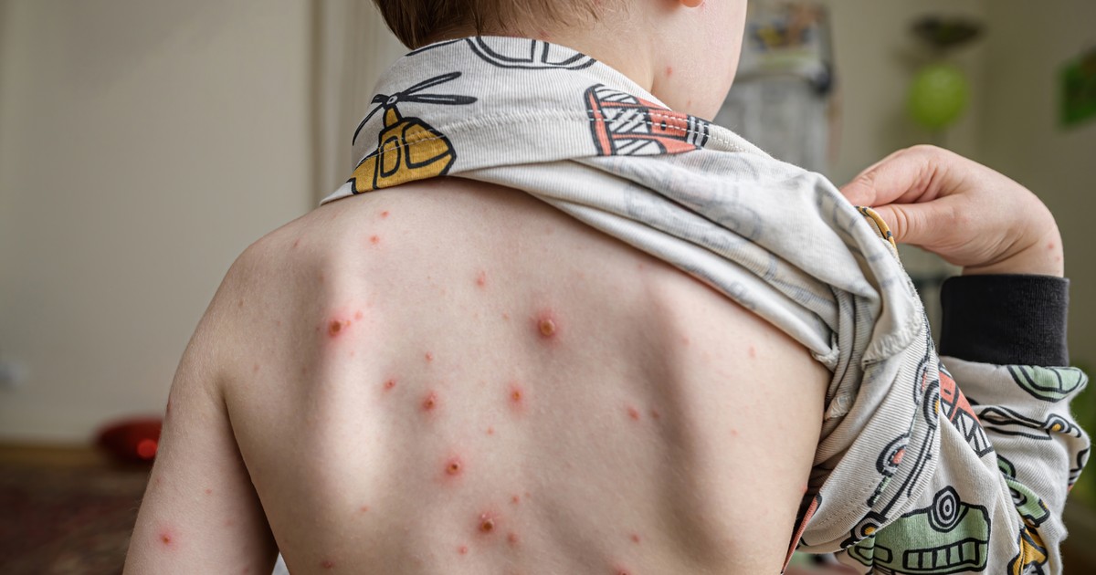 Ospa dzień po dniu. Chorobę dzieli się na kilka etapów