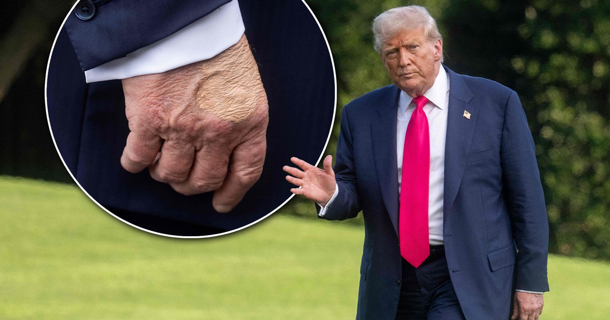 Tajemnicze plamy na dłoni Donalda Trumpa. Jest komentarz Białego Domu