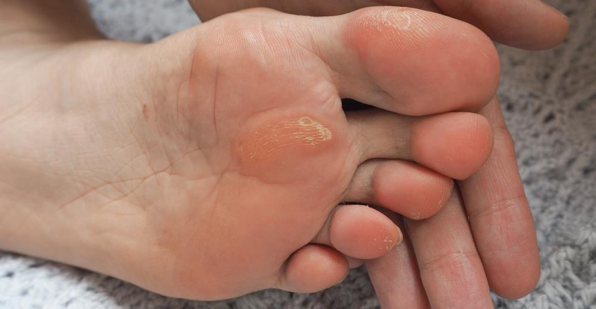 Modzele – jak wyglądają? Czym się różnią modzele od nagniotków? Domowe ...