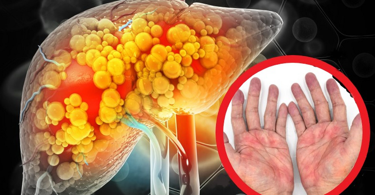 Jak poznać, że wątroba wysiada? "Wątrobowe dłonie" to nietypowy sygnał ...