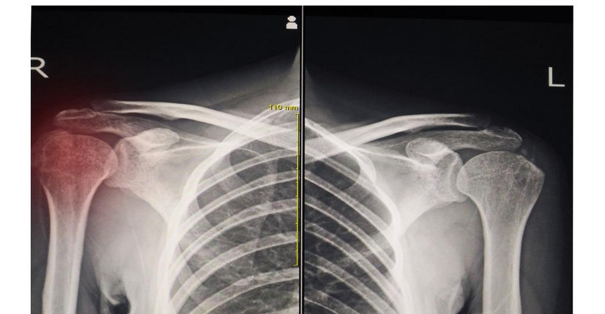 Złamania żeber - leczenie