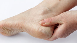 Modzele to szpecące odciski. Najlepsze domowe sposoby na modzele