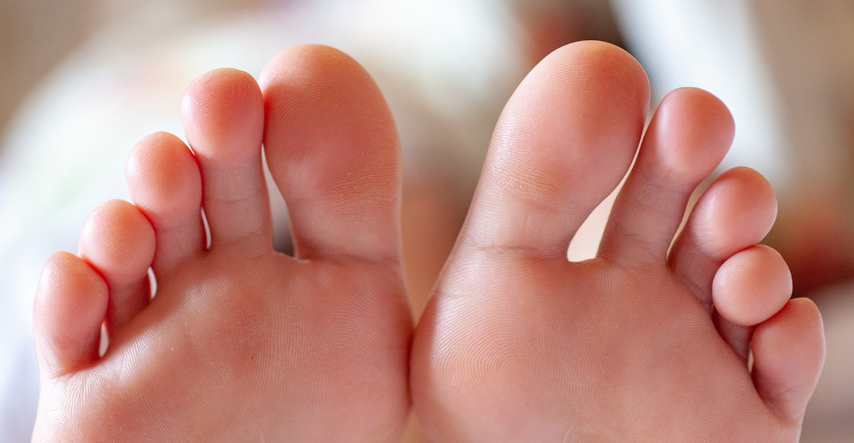 Grzybica stóp międzypalcowa wyparzeniowa - zdjęcia, przyczyny, objawy i ...