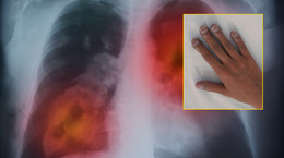 Nietypowy objaw raka płuc. Pojawia się na palcach i paznokciach. To tzw ...