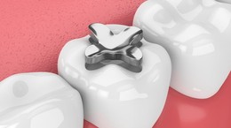 Plomba - kiedy się stosuje? Ile kosztuje założenie plomby?