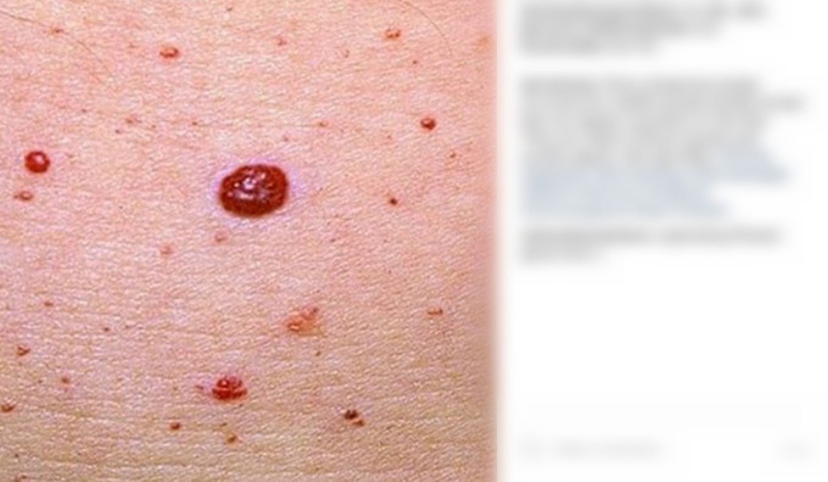 Primetili ste ove crvene tačkice na telu? Ako izgledaju OVAKO, obavezno ...