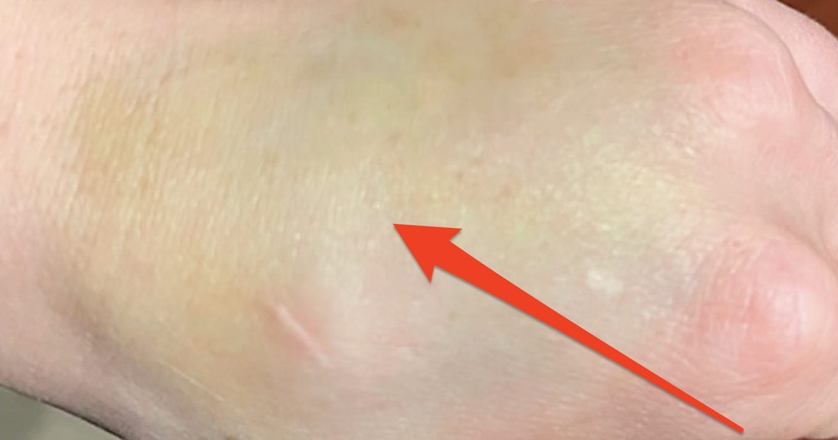 A woman thought she had a bruise from twisting her arm while doing yoga ...