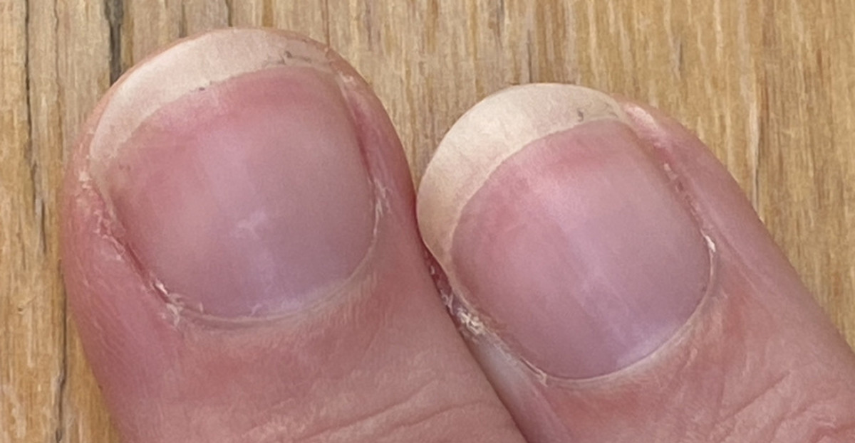 Objawy cukrzycy widać na paznokciach. Mały szczegół może być znaczący