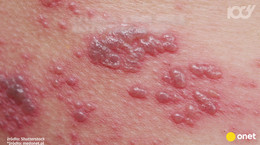 Półpasiec - objawy, leczenie, powikłania. Jak można się zarazić?