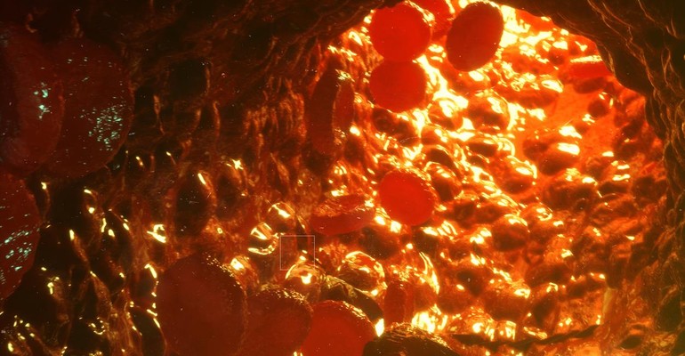 Hemoliza – objawy, przyczyny, leczenie