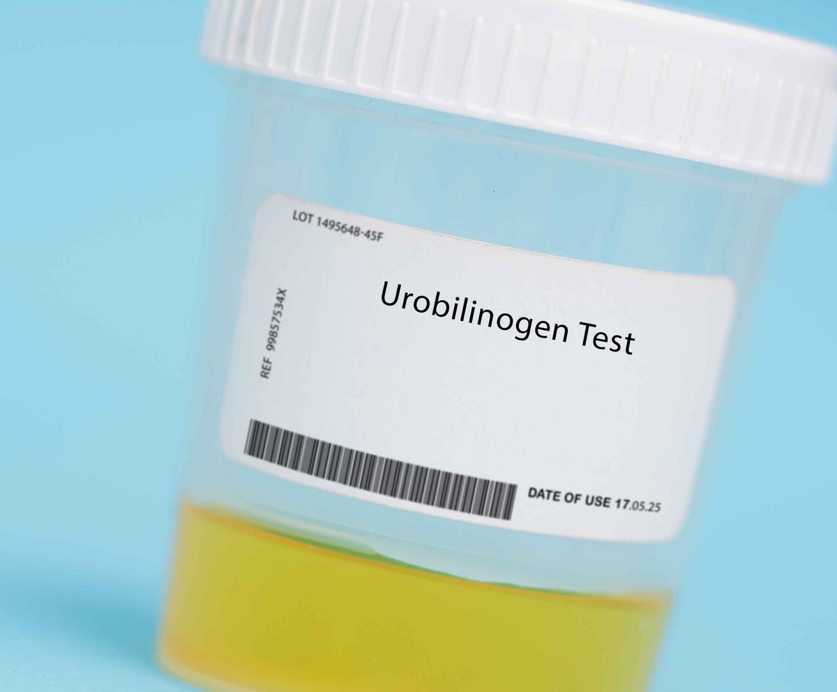Mit jelent az urobilinogén (UBG) érték a laborleleten? | EgészségKalauz