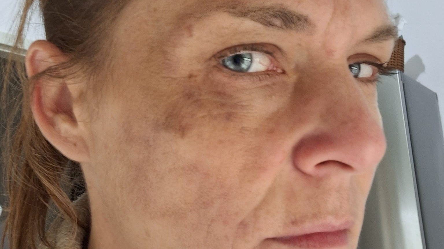 FOTO Feldekovej dcéra ukázala modriny a dobitú tvár: Čo sa stalo ...