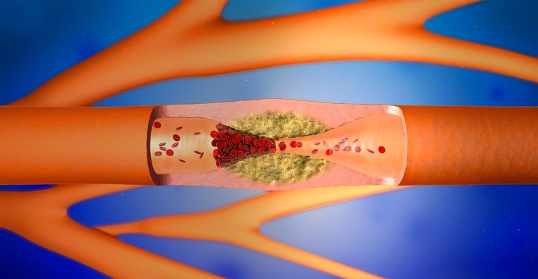 Vessel Due F- działanie, wskazania, stosowanie, skutki uboczne