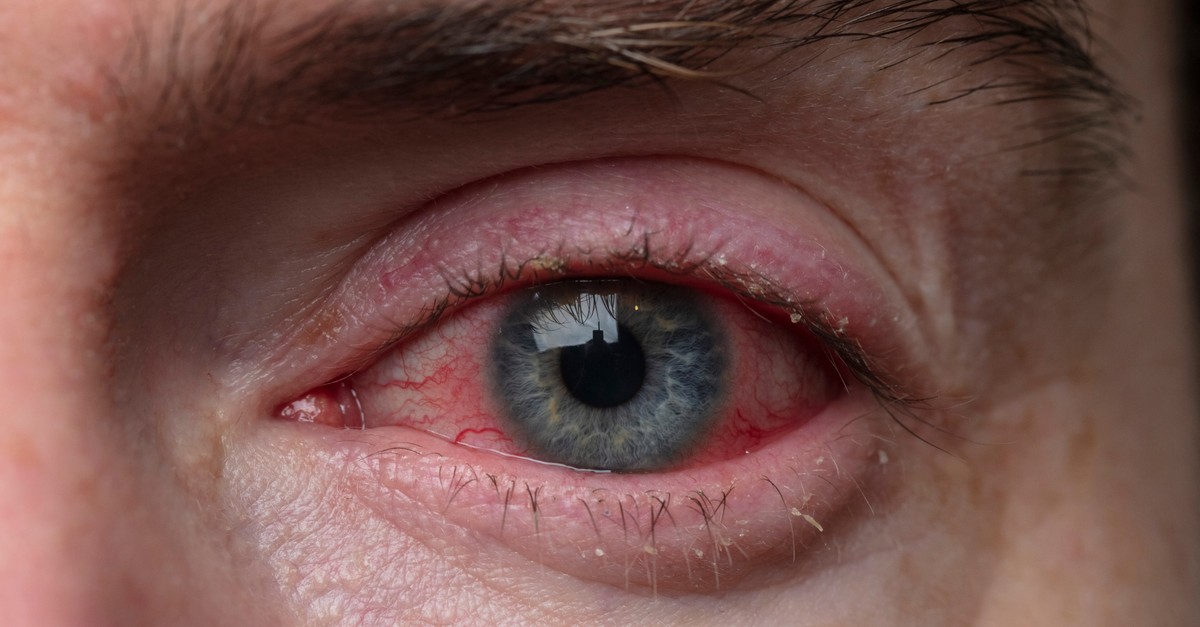 Nietypowy objaw zakażenia koronawirusem. Chorobę można rozpoznać po ...