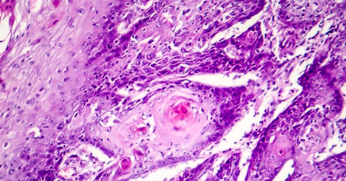 Rak płaskonabłonkowy - charakterystyka i rodzaje choroby