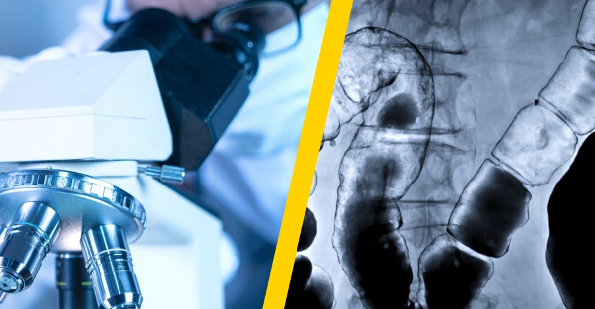 Lekarze "stopili" guza jelita grubego. Nie potrzebowali chemioterapii