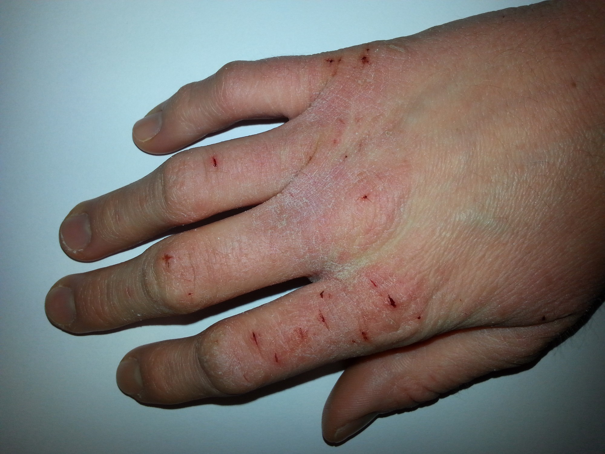 Atopický ekzém sa dá zvládnuť: Aký je život s týmto ochorením? | Najmama.sk