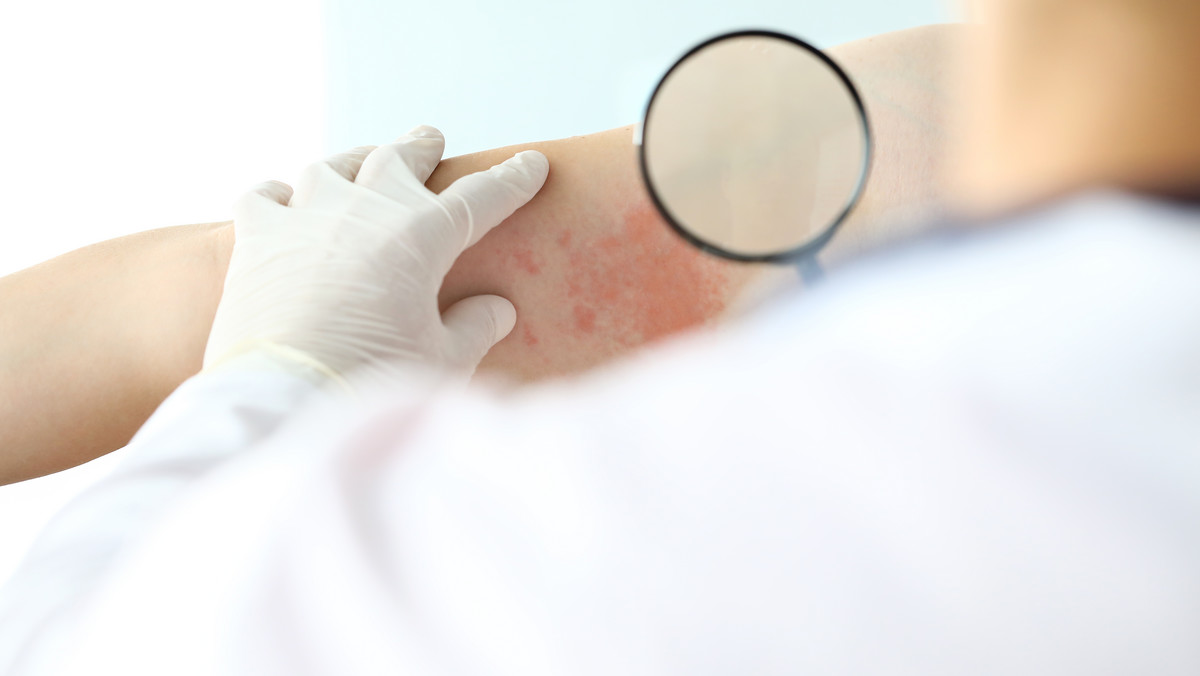 Półpasiec w ciąży – przyczyny, objawy, leczenie - Rodzina