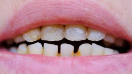 Plamy opadowe - czym są i gdzie najczęściej się lokalizują plamy ...