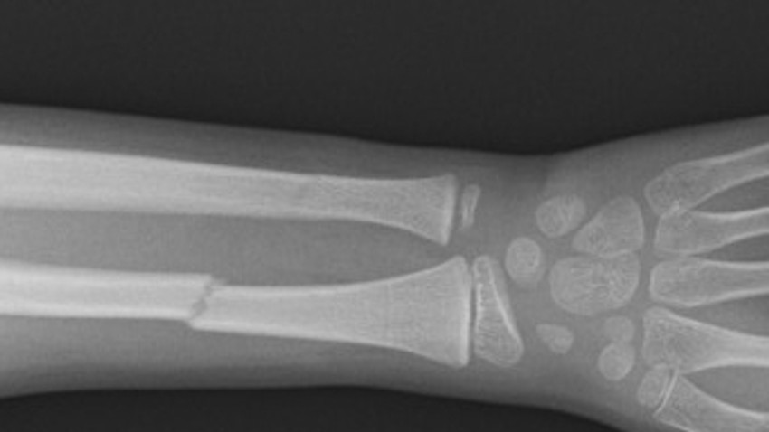 Nie zauważyła, że córeczka ma złamane rączki