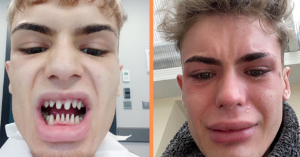 22-latek zrobił sobie "tureckie zęby". "Wyglądałem jak rekin" - Uroda