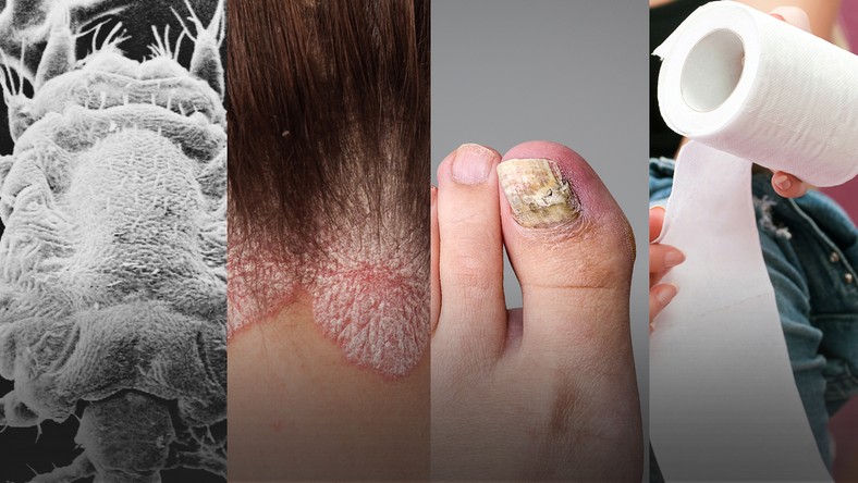 Choroby, których Polacy wstydzą się najbardziej: kiła, grzybica okolic ...