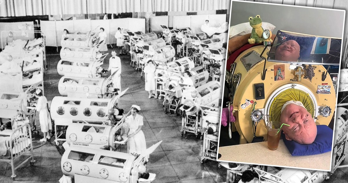 Nie żyje Paul Alexander. Przez 70 lat był uwięziony w żelaznym płucu