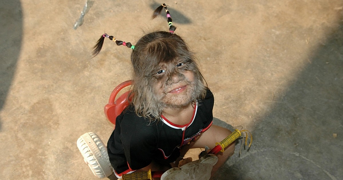 11-latka została rekordzistką w owłosieniu - Wiadomości