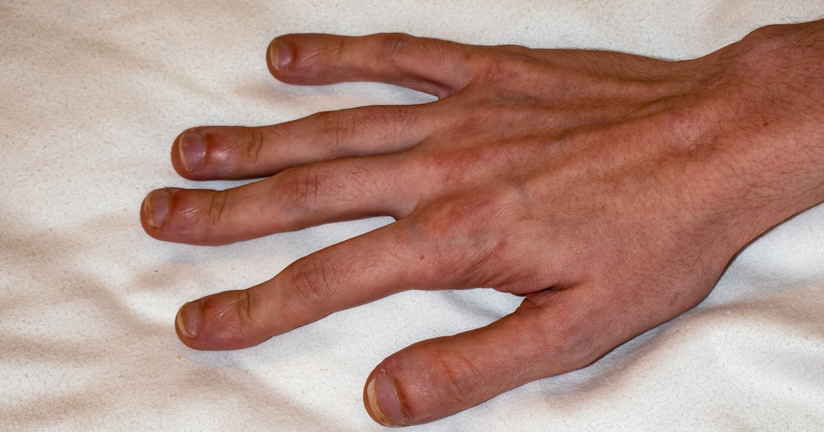 Rak płuc może dawać objaw na dłoniach. Tak wyglądają "palce Hipokratesa ...