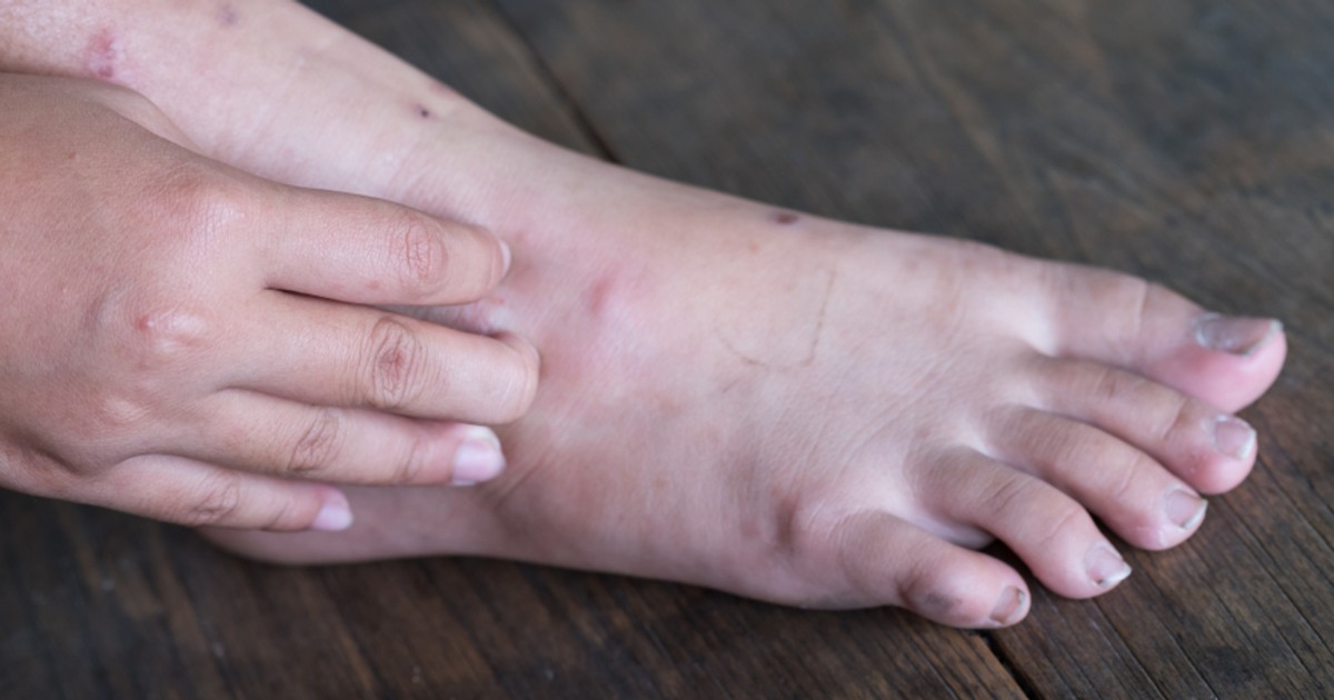 Gangrena – rodzaje, objawy, leczenie - Zdrowie