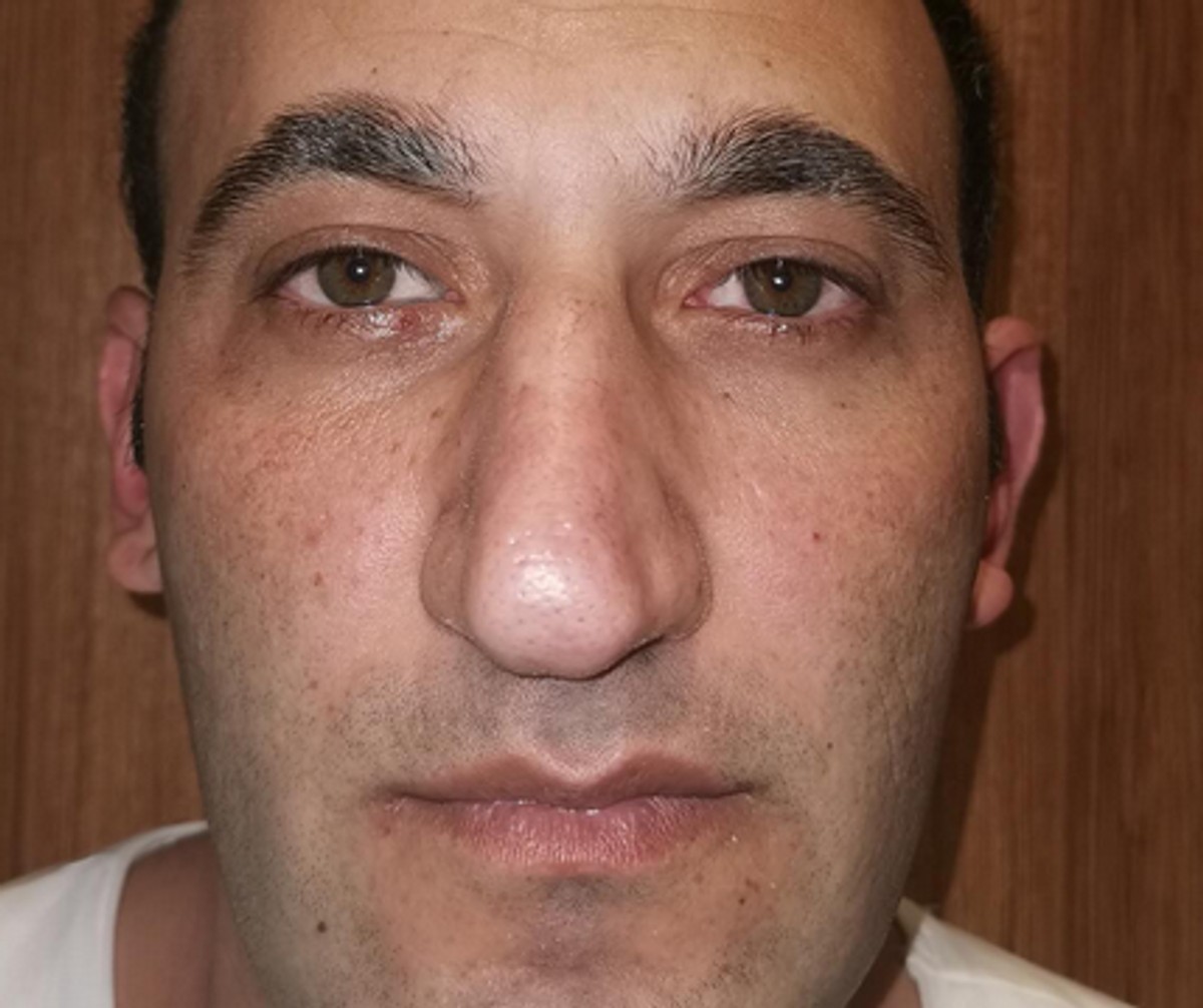 Ovako je izgledao pre, a posle plastičnih operacija je frajer od čije ...