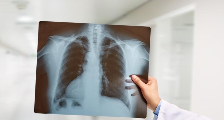 RTG płuc - jak interpretować wyniki?