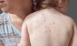 Ospa dzień po dniu. Chorobę dzieli się na kilka etapów