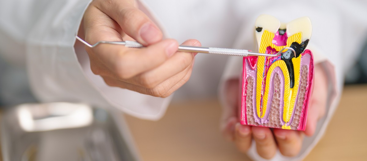 A fogszuvasodás oka, tünetei és kezelési lehetőségei | EgészségKalauz