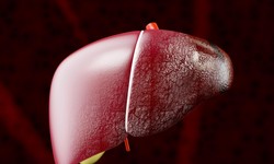 Wszy - objawy, leczenie i zapobiegania wszawicy u dzieci i dorosłych ...