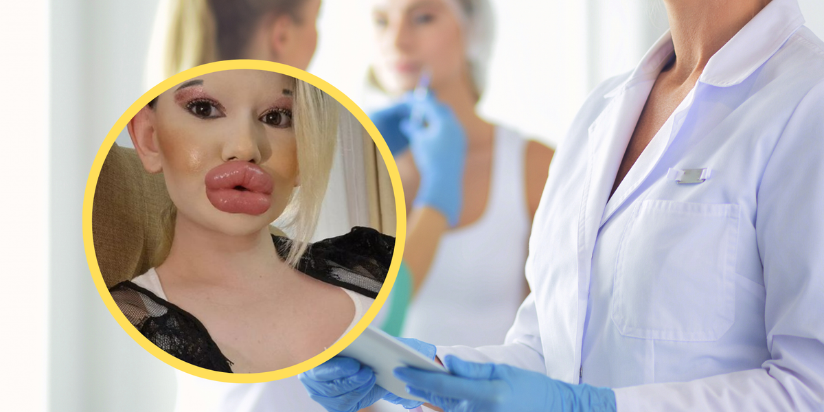 Ma największe usta na świecie i chce wyglądać jak Barbie. Wydała na to ...