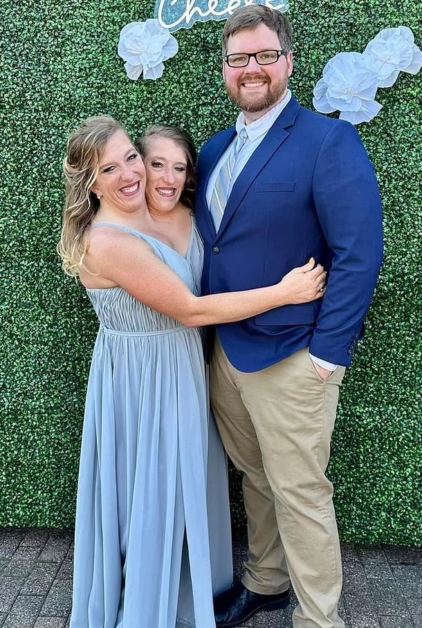 Egy testtel és két fejjel született a sziámi ikrek, de külön családot ...