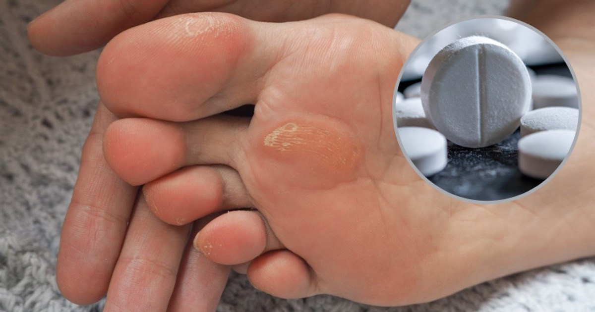 Domowe sposoby na odciski na stopach. Koniecznie wypróbuj okład z aspiryny