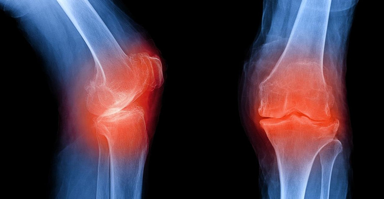 Osteofity, czyli narośla kostne - przyczyny, objawy, leczenie