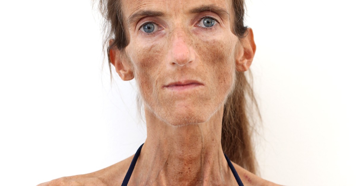 Zadziwiająca przyczyna anoreksji u kobiet - Kobieta