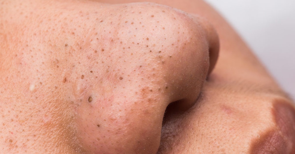 Beauty Tips Safe And Effective Ways To Remove Deep Blackheads Pulse