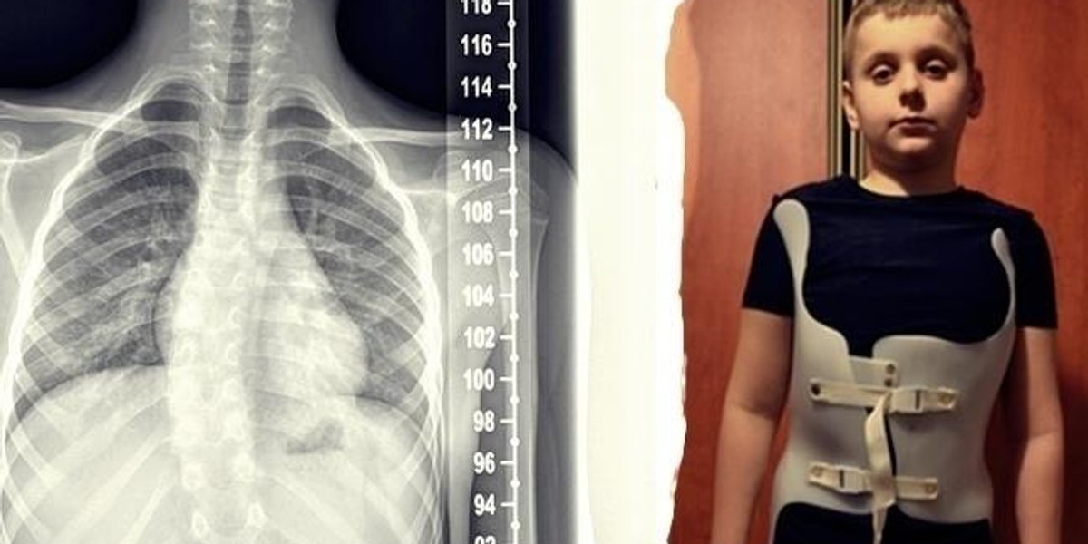Skolioza wykrzywia ciało Bartka. Konieczna jest regularna rehabilitacja ...