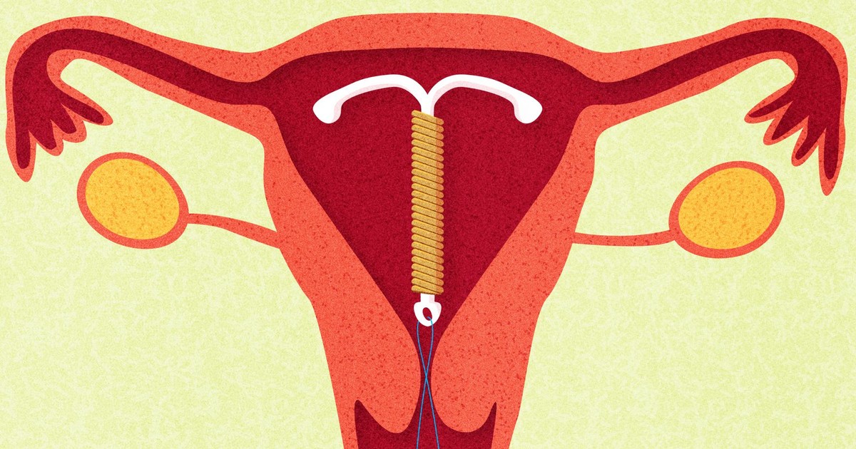 8 Things You Need To Know About Sex When You Have An Iud Pulse Nigeria