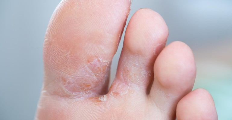 Grzybica stóp - objawy. Ile trwa leczenie grzybicy stóp?