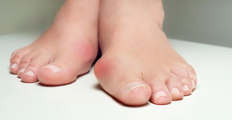 Haluksy - przyczyny, profilaktyka, leczenie. Operacja haluksów