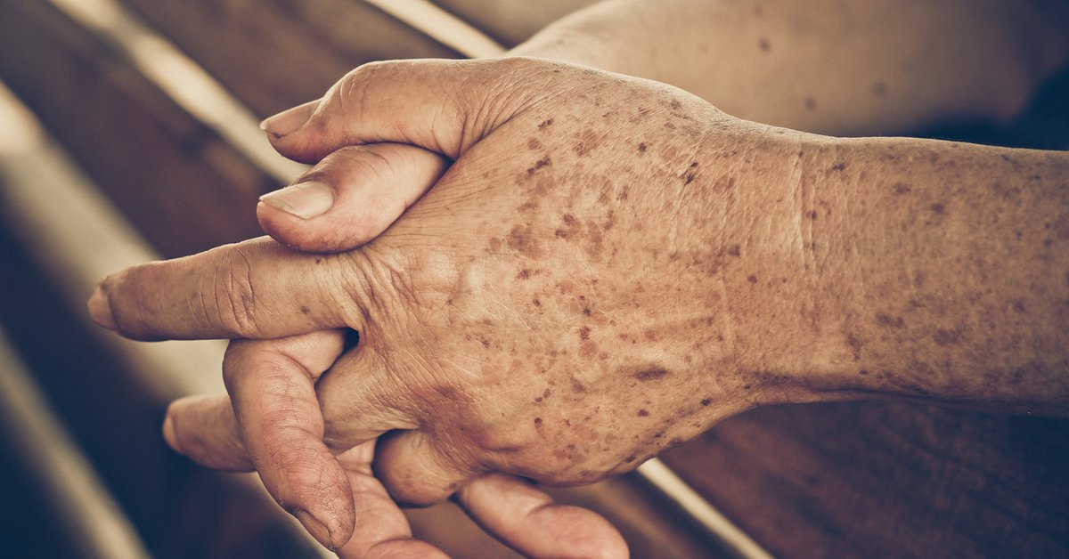 Plamy na rękach? Są na to domowe sposoby - Styl życia