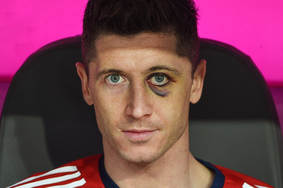 Robert Lewandowski z podbitym okiem - mocne zdjęcia - Sport