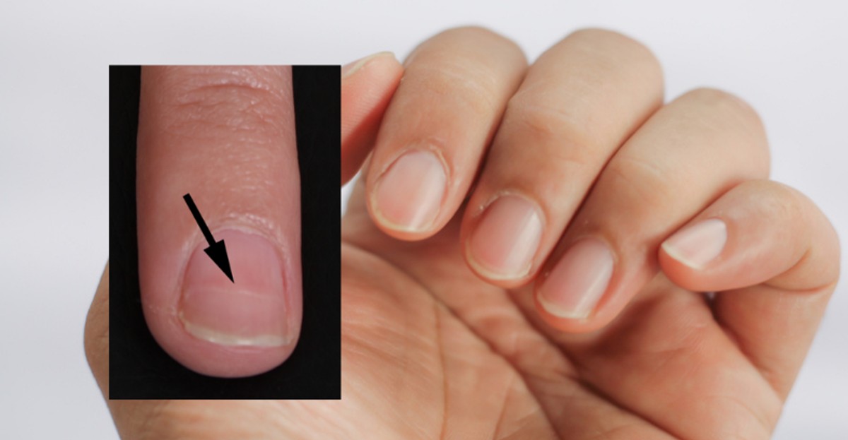 Linie Beau - co oznaczają? Jak zdiagnozować i leczyć linie Beau?