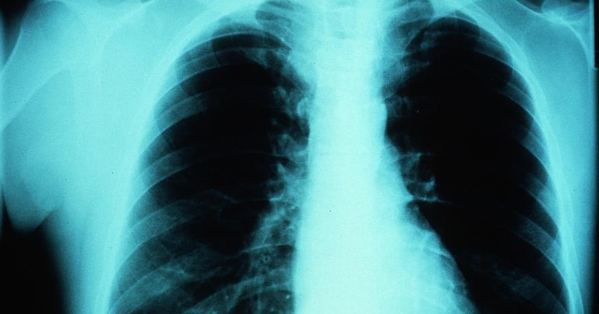 RTG - na czym polega? Przygotowanie, przebieg i skutki badania RTG
